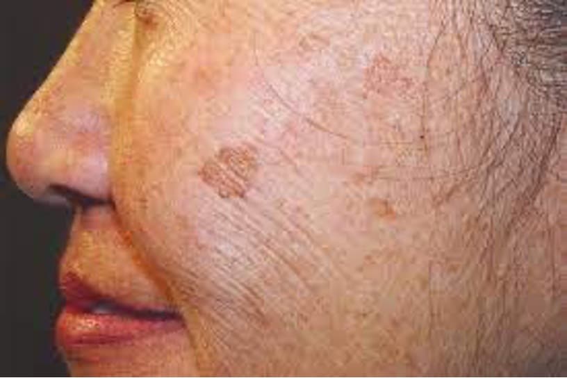 Age Spot Removal Healthium Clinics